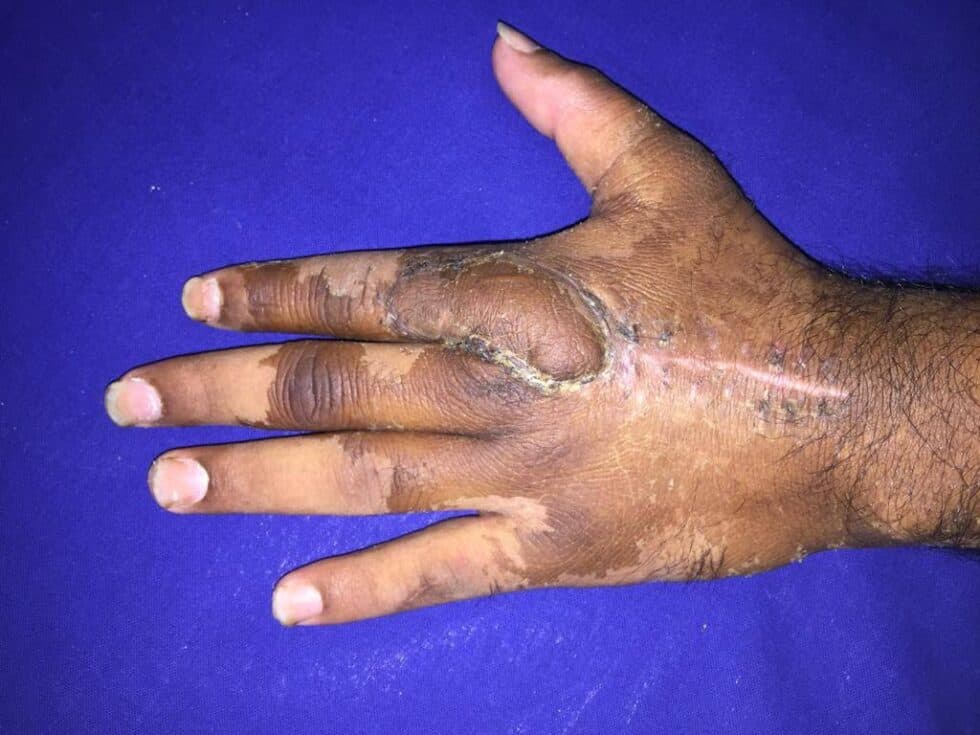 First Dorsal Metacarpal artery flap (QUABA FLAP) - Dr. Sathya Vamsi Krishna